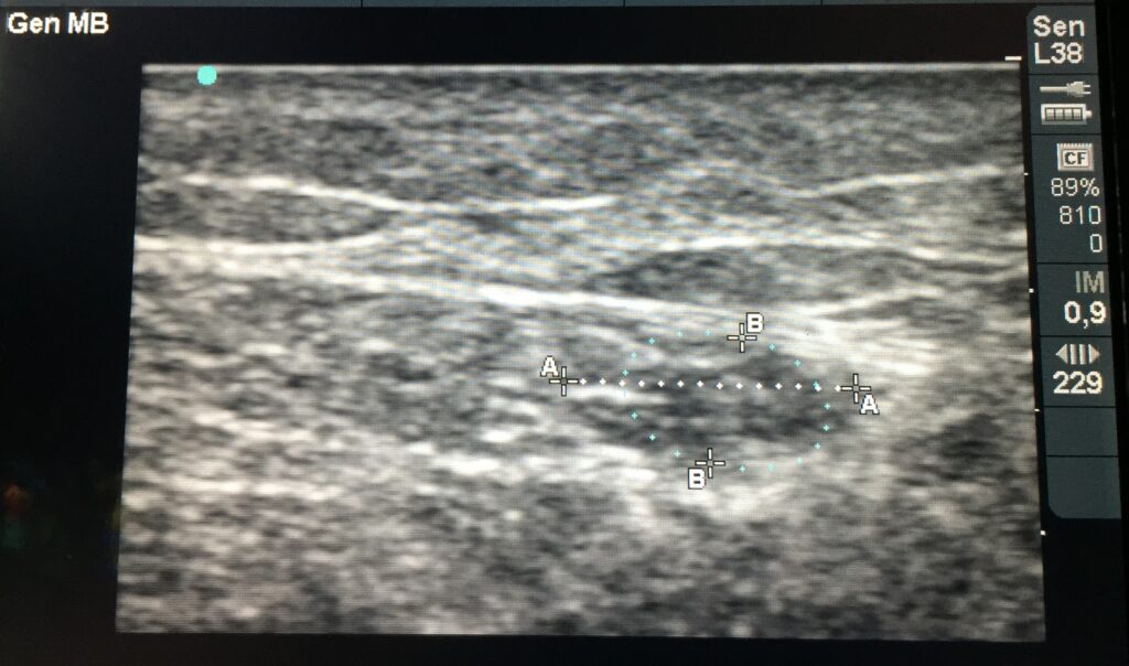 Riabilitazione – dolore Strappo del polpaccio | STUDIO DR CIVITILLO